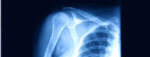 Partial vs Full Rotator Cuff Tear: What's the Difference - OrthoKau ...
